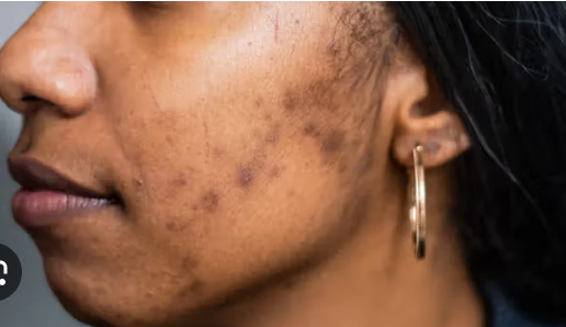 Dark Spots vs Uneven Skin Tone: Why Your Complexion Looks Dull – Chicnutrix